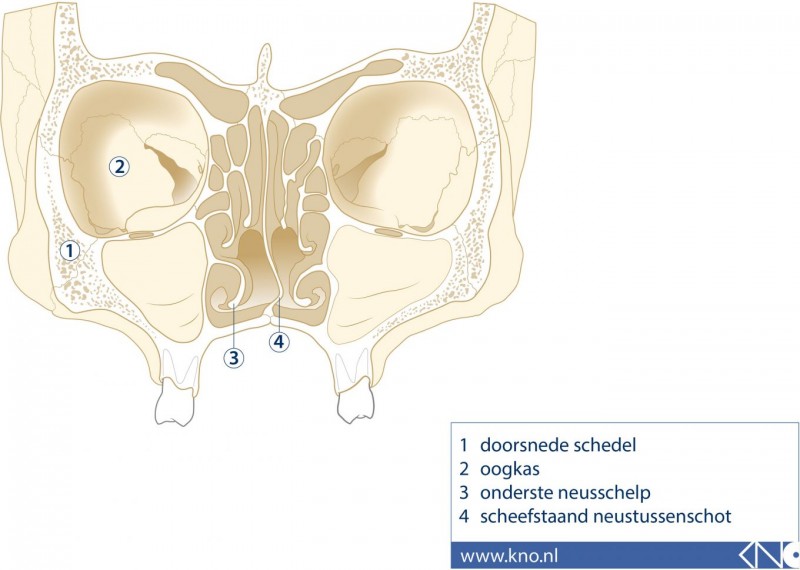 Operaties aan de neus - Keel-Neus-Oorheelkunde en Heelkunde van het ...