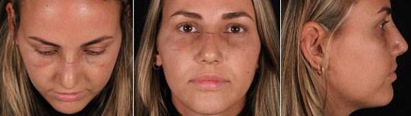 Operaties aan de neus - Keel-Neus-Oorheelkunde en Heelkunde van het ...