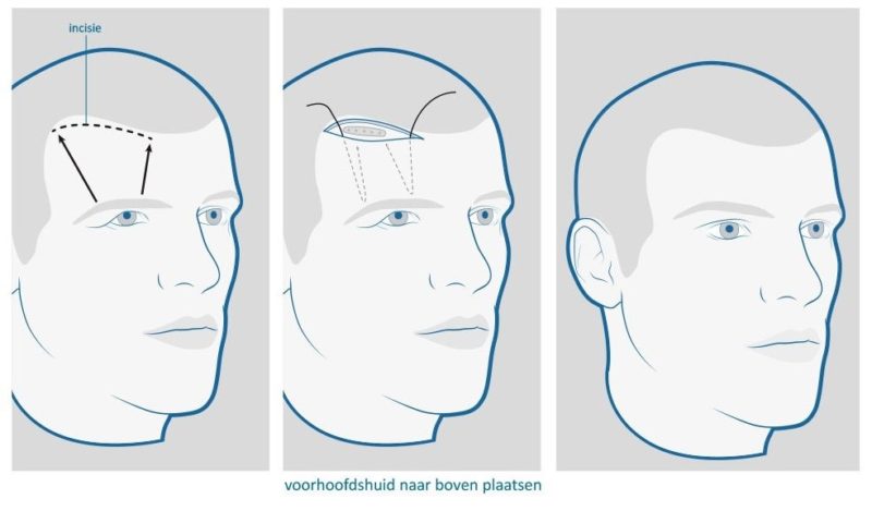 Facialiscorrectie bij facialisverlamming - Keel-Neus-Oorheelkunde en ...