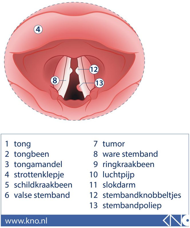 Goedaardige afwijkingen in en/of op de stembanden - Keel-Neus ...