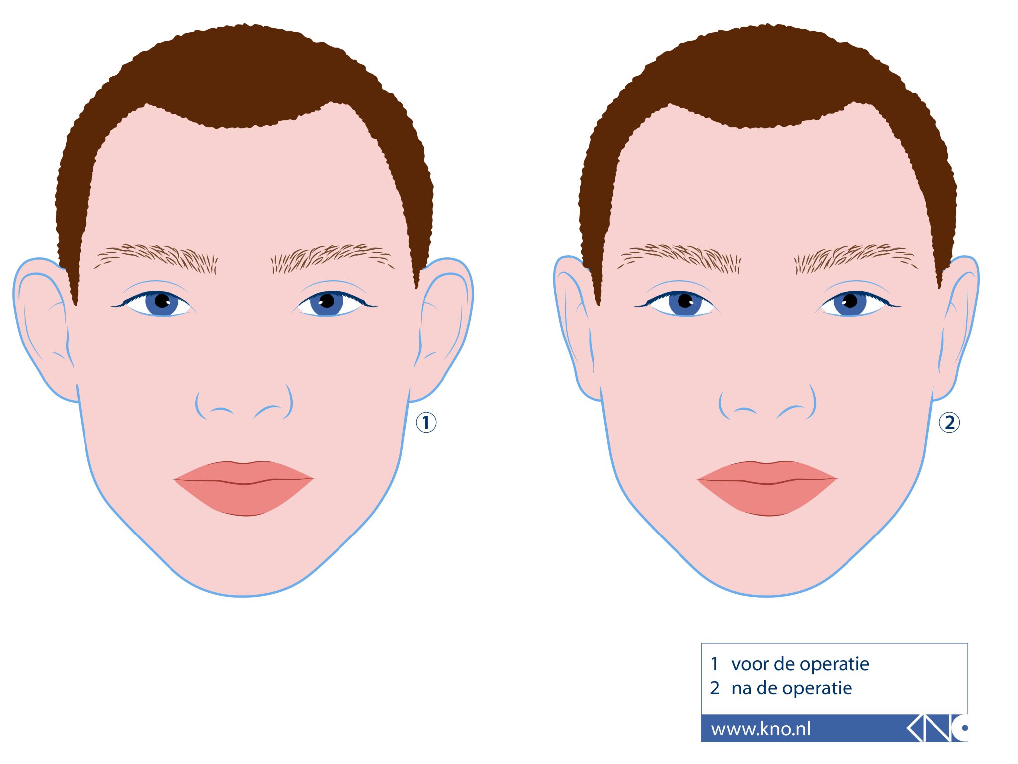 Afstaande oren - Keel-Neus-Oorheelkunde en Heelkunde van het Hoofd ...