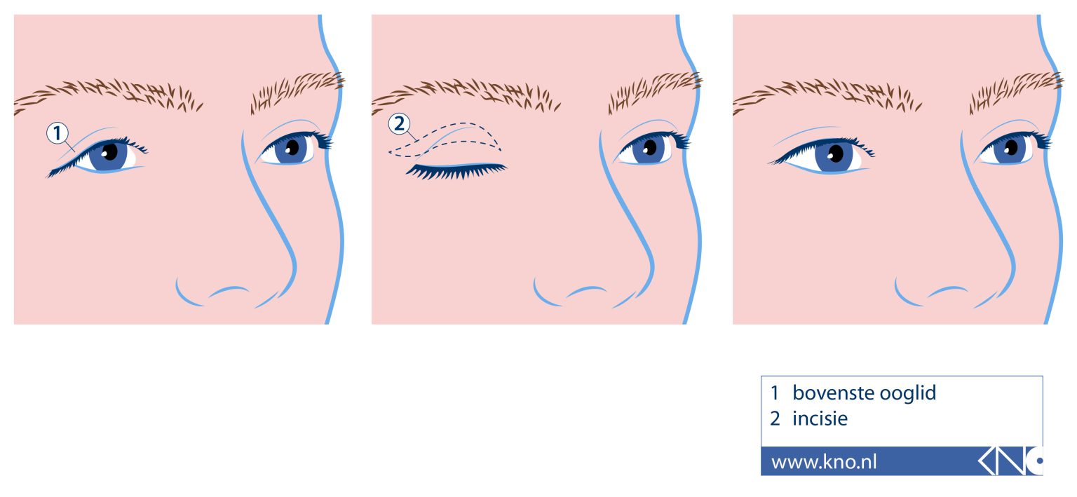 Ooglidcorrecties - Keel-Neus-Oorheelkunde en Heelkunde van het Hoofd ...
