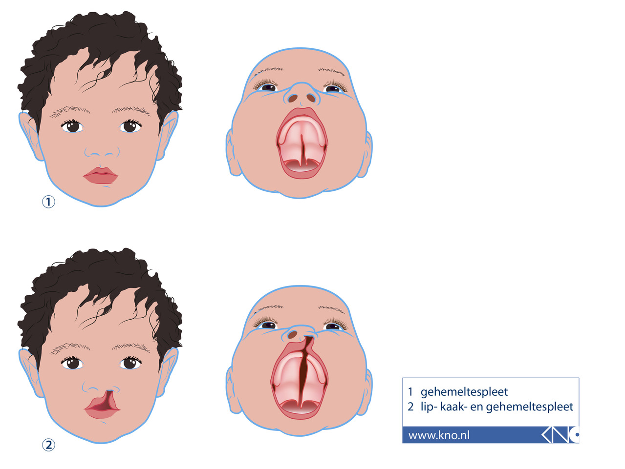 Schisis - Keel-Neus-Oorheelkunde en Heelkunde van het Hoofd-Halsgebied